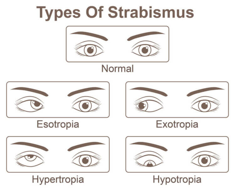 Strabismus Ashland | Crossed Eyes Ashland, KY | Tri-State Ophthalmology