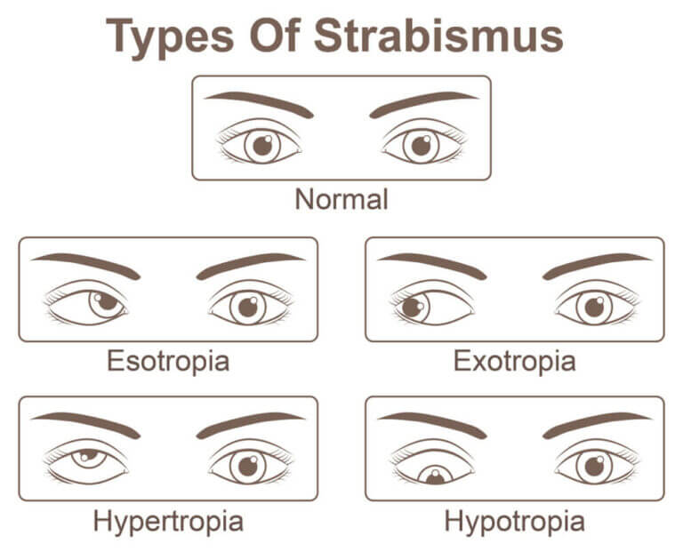 Strabismus Ashland | Crossed Eyes Ashland, KY | Tri-State Ophthalmology